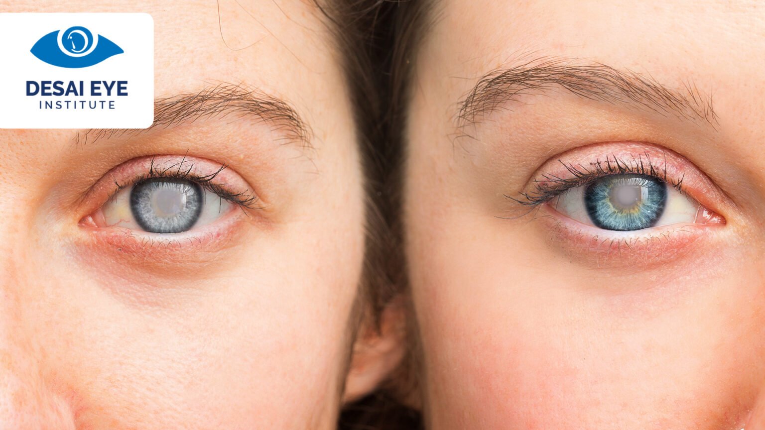What is the Difference Between Cataract and Glaucoma? - Desai Eye Institute
